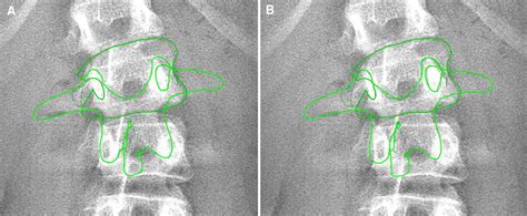 Position Of The Vertebral Model For Apical Vertebra L2 Before A And