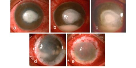 Digital Image Of A Patient With Rapidly Proliferative Pythium Download Scientific Diagram