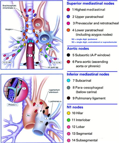Thoracic Nodal Stations In 2022 Lymph Nodes