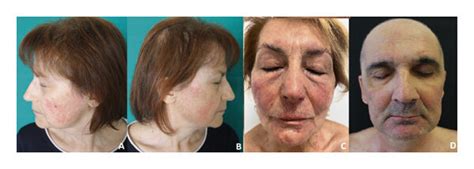 Relapse Of Papulopustular Rash After Mask Use Localized On Cheeks And Download Scientific