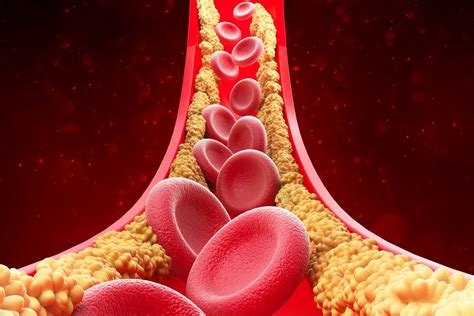 What Causes High Cholesterol