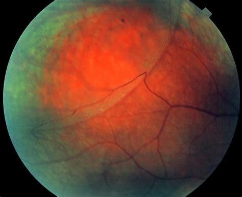 Retinoschisis Of The Eyes Retina Photograph By Science Photo Library