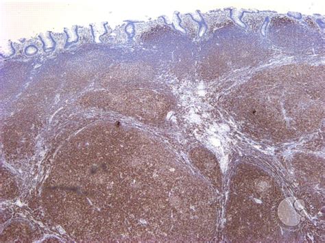 Follicular Lymphoma Grade 1 3 In A Hepatic Flexure Polyp 5