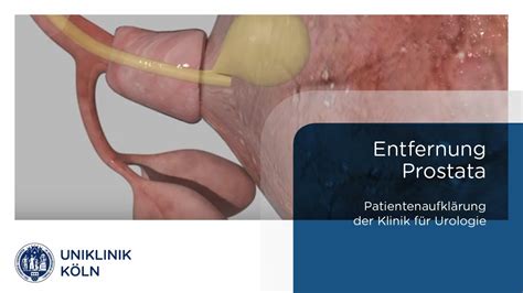 Prostatakrebs Entfernung Der Prostata Klinik Für Urologie