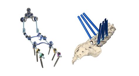 Zimvie Expands Development Agreement With Brainlab