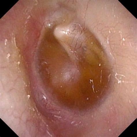 Otitis Externa With Effusion