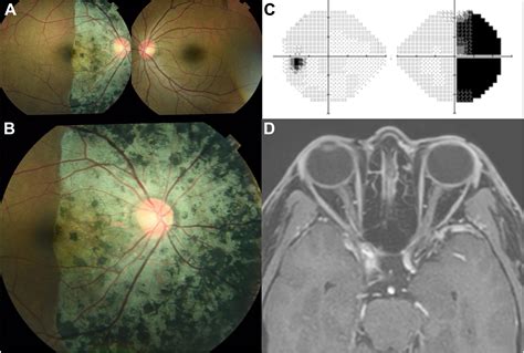 Monocular Temporal Hemianopsia And Retinopathy Ophthalmology