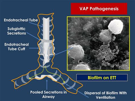 Ppt Vap A Preventable Disease Powerpoint Presentation Free Download Id 4459271