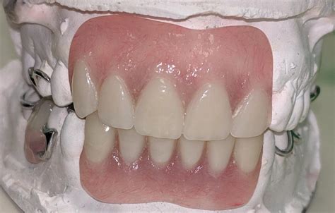 Partial Denture Metal