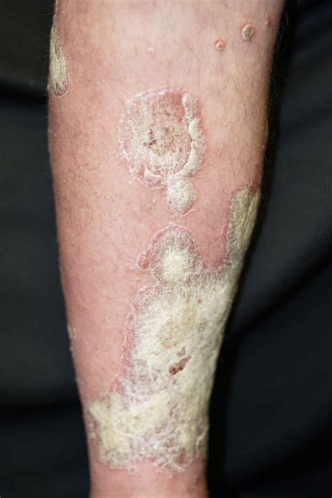 Plaque Psoriasis Legs