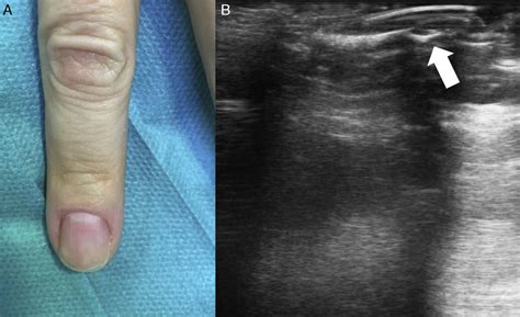 Ultrasound Guided Minimally Invasive Resection Of A Digital Glomus Tumor Actas Dermo