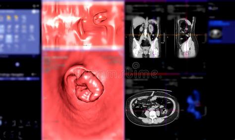 Ct Colonography 3d Rendering Image Showing Colon For Screening Colorectal Cancer Stock