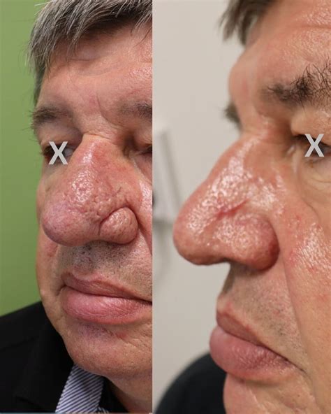 Rhinophyma Co To Je Proč Vzniká A Jak Se Dá řešit Dermaestet