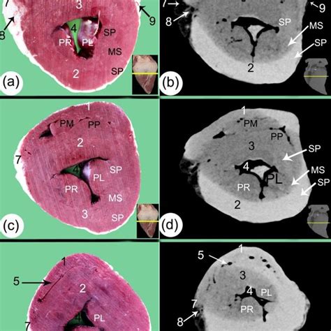 Transverse Gross Sections A C E And Soft Tissue Window Ct Scans B