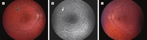 Outer Retinal Corrugations In X Linked Juvenile Retinoschisis