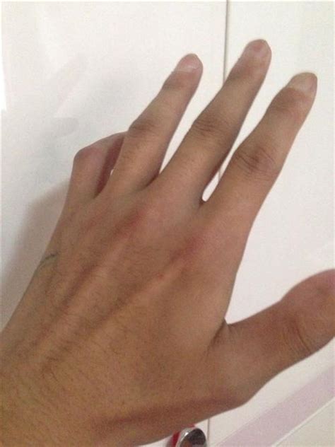 手肌肉萎缩多图 39医疗图集 39健康网