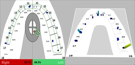 Force Distribution On Occlusal Splints Using T Scan 57 Off