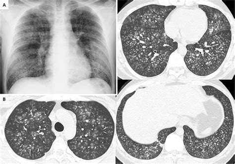 Chest Radiography On Admission Showing Diffuse Reticulonodular