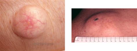 Benign Skin Growths Flashcards Quizlet