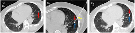 Computed Tomography Guided Coil Localization And Uniportal Video Assisted Thoracic Surgery