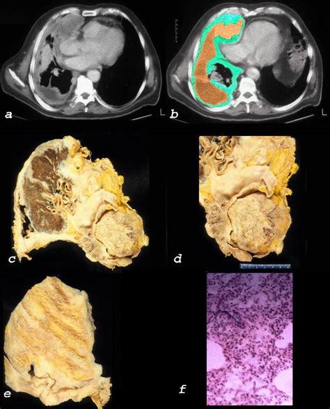 000 Split Pleura Sign The Common Vein