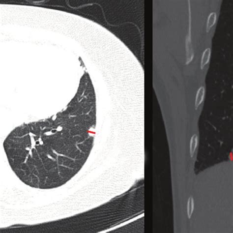 Measurement Of The Tumor Depth The Tumor Depth Red Line Was Defined