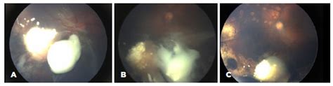 Arquivos Brasileiros De Oftalmologia Erg And Oct Abnormalities In Retinoblastoma After