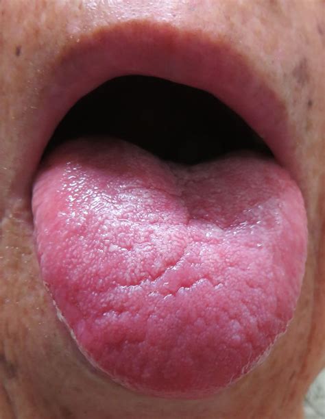 Glossitis Median Rhomboid Glossitis Pocket Dentistry