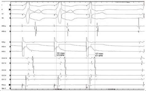 Right Sided Accessory Pathways Thoracic Key