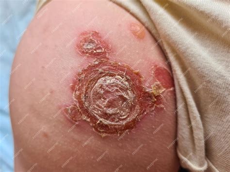 Premium Photo Close Up Of A Ringworm Rash On A Persons Shoulder