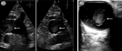 Floating Thrombus Of The Ascending Aorta Arrow A Two Dimensional