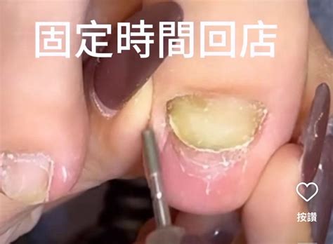 黑特 灰指甲 綠膿 是可以做凝膠上去的嗎？ 美甲板 Dcard