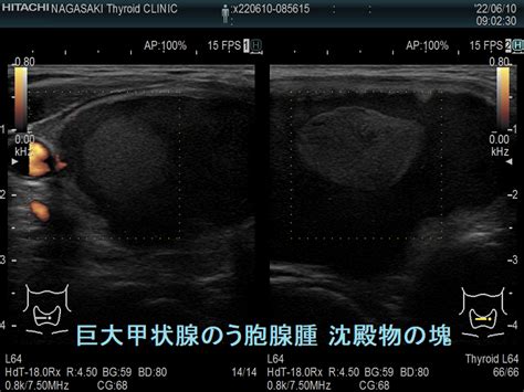甲状腺のう胞型濾胞腺腫 のう胞腺腫 橋本病 バセドウ病 甲状腺超音波 長崎甲状腺クリニック大阪