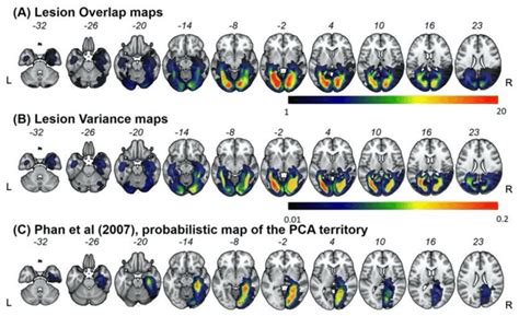 Lesion Overlap And Variance Maps For The 64 Pca Stroke Cases L Left
