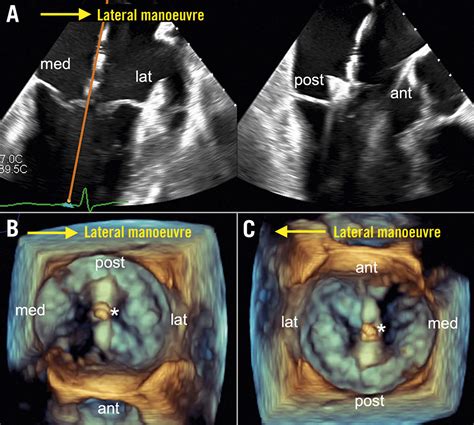 Mitral Valve Anatomy On Tee At Erica Valentin Blog