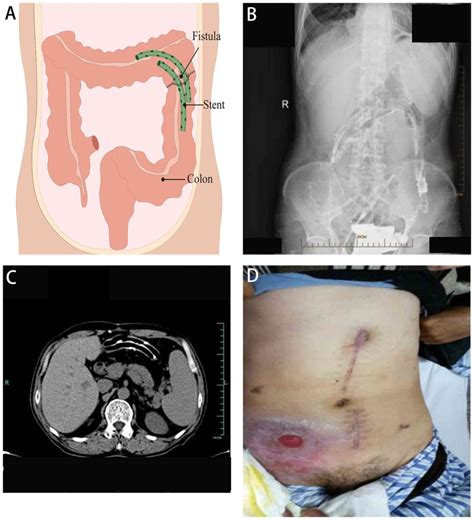 Complex Intestinal Fistula Treated With Colon‑indwelling Drainage Stent