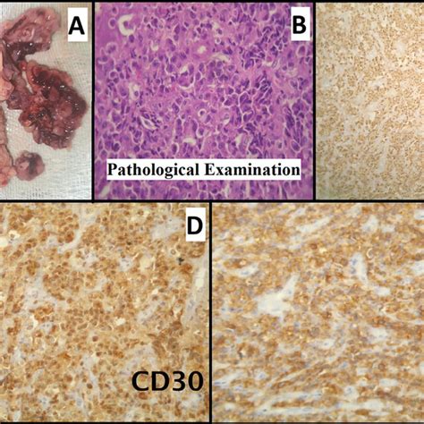 A Preoperative Image Shows The Macroscopic Aspect Of The Lesion B Download Scientific