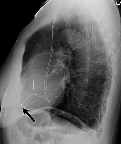 Chest X Ray Lateral View Chest Radiography In The Icu Part 2