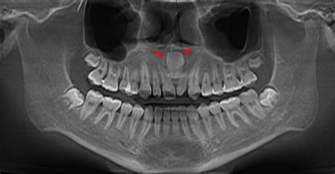 Dilaceración Radicular De Un Incisivo Central Superior Dento Metric