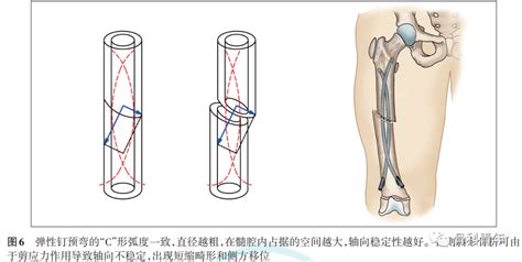 骨科精读 一文总结弹性髓内钉技术的力学原理与应用原则！ 上海开为医药科技有限公司 创伤、肢体矫形技术解决方案的专业服务商