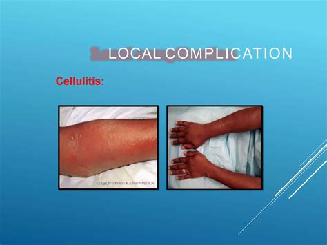 Intravenous Injection Ppt Pptx