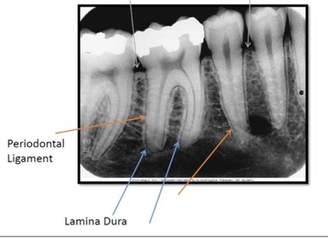 Interpretation Of Periodontal Disease Flashcards Quizlet