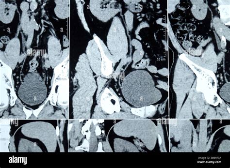 Ct Scan Of Abdomen And Pelvis Shows Left Upper Ureteric Stone With Mild Back Pressure Effect