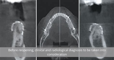 Yxoss Mesh Customised Bone Regeneration Course Dental Iceberg