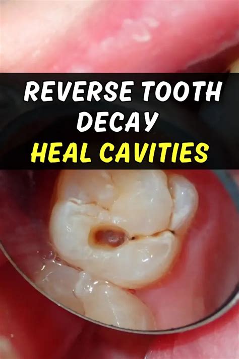 Reverse Tooth Decay Naturally Discover The Easy Steps To Heal Your Teeth
