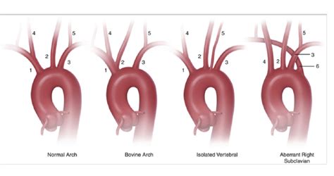 2 Aortic Arch Branching Patterns 1 Brachiocephalic Artery 2 Left