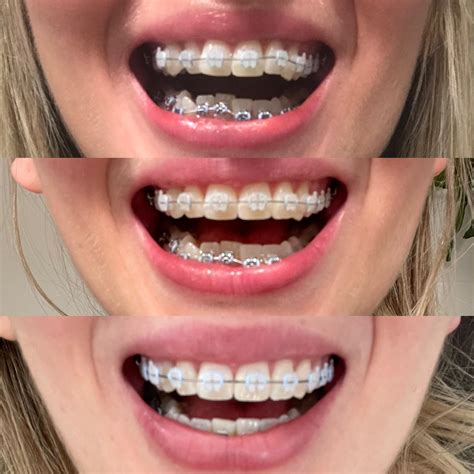 3 Months Progress Braces