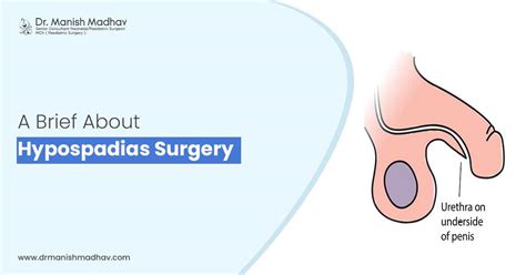 Epispadias And Hypospadias Hypospadias