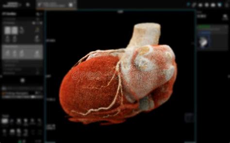 Realistic 3d Heart Cta Scana Detailed Cta Scan Showing The Coronary