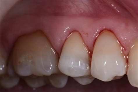 Absolute Isolation For Class V Restorations